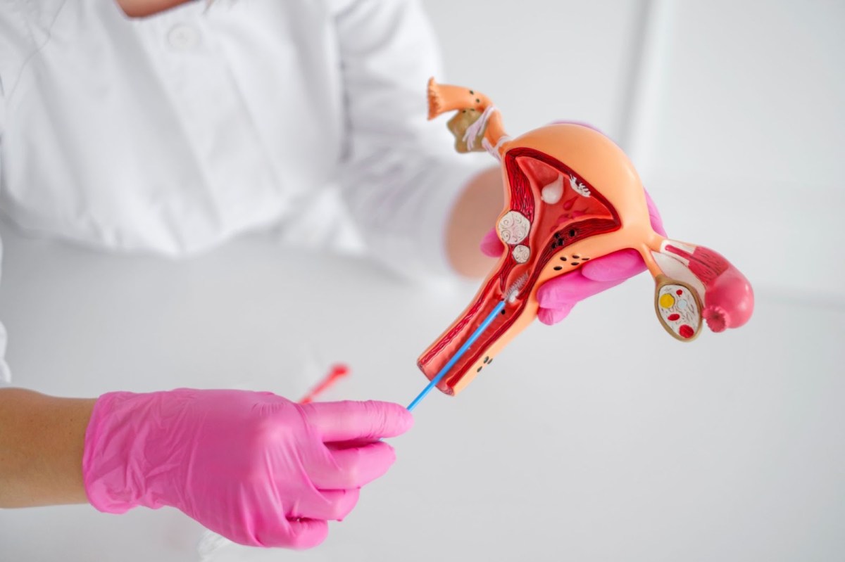 Advancements in Cervical Cancer Screening: FDA Approves HPV Self ...